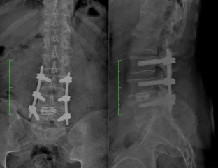 Full Percutaneous Treatment of Degenerative Disc Disease with ...