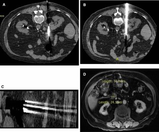 Percutaneous Cryoablation of Recurrent Pancreatic Mass for Life ...