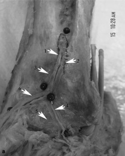 Enlarged perforating branch of peroneal artery and extra crural fascia ...