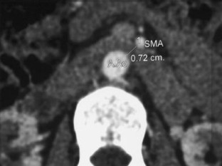 Measurement of the distance and angle between the aorta and superior ...