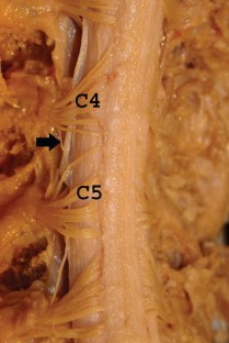 The prefixed and postfixed brachial plexus: a review with surgical ...