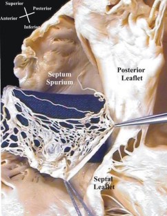 Chiari’s network: review of the literature | SpringerLink