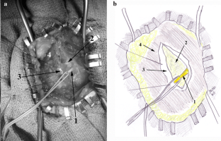 Anatomical basis of transgluteal approach for pudendal neuralgia and ...