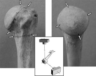 Medial calcar of proximal humeral fracture as landmark in restoration ...