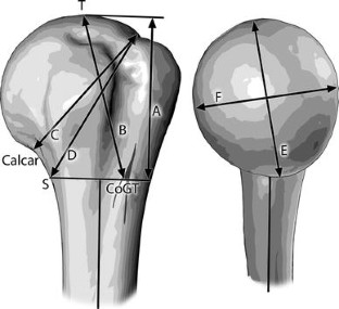 Medial calcar of proximal humeral fracture as landmark in restoration ...