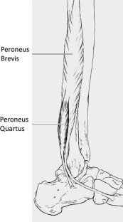The accessory peroneal (fibular) muscles: peroneus quartus and peroneus ...