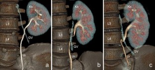 Kinking of the upper ureter in CT urography: anatomic and clinical ...