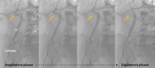 Kinking of the upper ureter in CT urography: anatomic and clinical ...