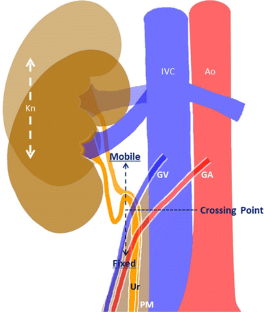 Kinking of the upper ureter in CT urography: anatomic and clinical ...