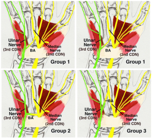 A comprehensive review of motor innervation of the hand: variations and ...
