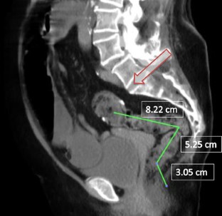 Is it possible to give a single definition of the rectosigmoid junction ...