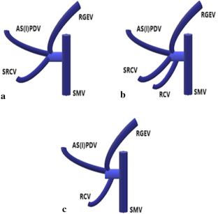 Gastrocolic trunk of Henle and its variants: review of the literature ...