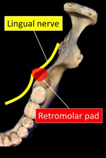 How to avoid iatrogenic lingual nerve injury in the retromolar area: an ...