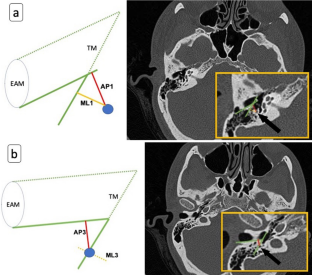 Radiologic evaluation of the mastoid segment of the facial nerve tract ...