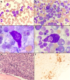 Systemic mastocytosis with associated BCRABL1 -negative atypical chronic myeloid leukemia ...