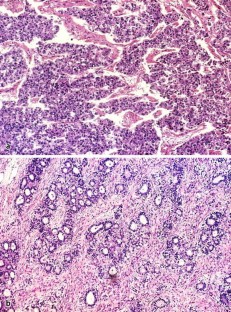 Teratome des Ovars | SpringerLink