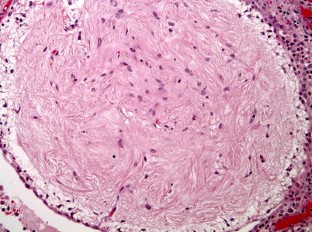 Teratome des Ovars | SpringerLink