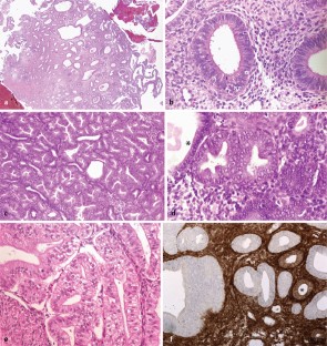 Vorläuferläsionen des Endometriumkarzinoms | SpringerLink