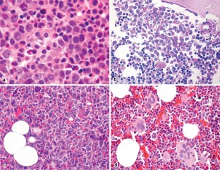 Normales Knochenmark und häufige reaktive Veränderungen | SpringerLink