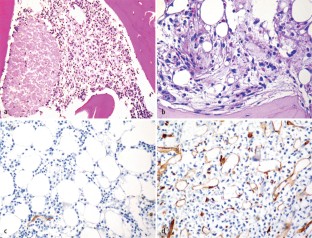 Normales Knochenmark und häufige reaktive Veränderungen | SpringerLink
