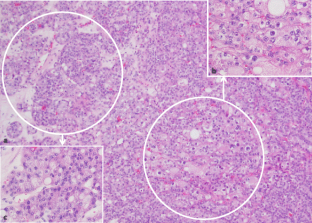 Onkozytom versus chromophobes Nierenkarzinom | SpringerLink