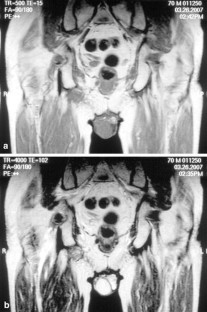 Ischiogluteal bursitis: a report of three cases with MR findings ...