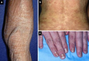 Cutaneous manifestations associated with rheumatoid arthritis ...