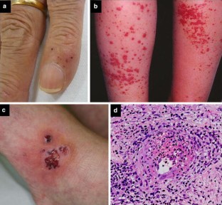 Cutaneous manifestations associated with rheumatoid arthritis ...