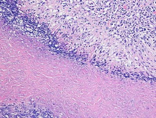 Recurrent pneumothorax associated with pulmonary nodules after ...