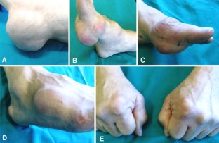 A clinical picture of chronic polyarticular tophaceous gout | SpringerLink