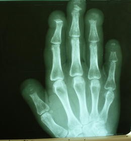 Primary hypertrophic osteoarthropathy | SpringerLink