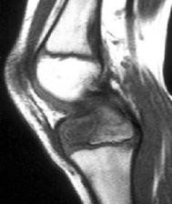 The penumbra sign in subacute osteomyelitis | SpringerLink