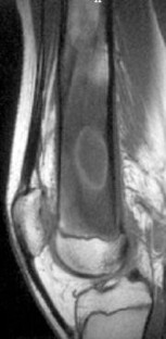 The penumbra sign in subacute osteomyelitis | SpringerLink