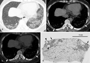 Disseminated dendriform pulmonary ossification associated with usual ...