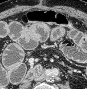 Multidetector computed tomography enteroclysis (MDCT-E) with neutral ...
