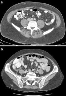 CT appearance of the normal appendix in adults | SpringerLink