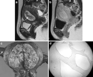 Pathologies of the uterine endometrial cavity: usual and unusual ...