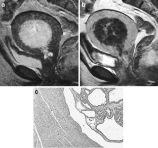 Pathologies of the uterine endometrial cavity: usual and unusual ...