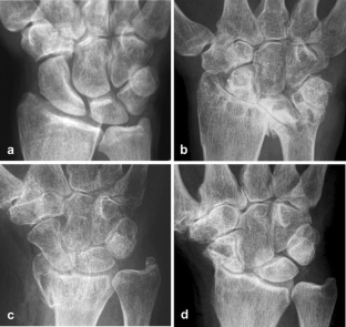 Carpal instability | SpringerLink