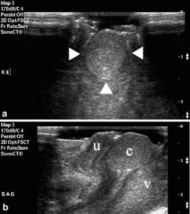 High-resolution perineal ultrasound of a paraurethral cyst in a neonate ...