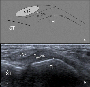 Ultrasound assessment of the spring ligament complex | SpringerLink