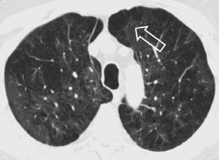 CT of pulmonary emphysema - current status, challenges, and future ...