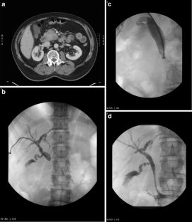 Percutaneous transhepatic biliary drainage (PTBD) with or without ...