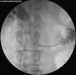 Percutaneous transhepatic biliary drainage (PTBD) with or without ...