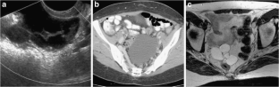 Peritoneal inclusion cysts: clinical characteristics and imaging ...