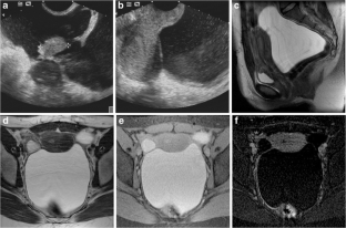 Peritoneal inclusion cysts: clinical characteristics and imaging ...