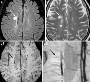 The “central vein sign”: is there a place for susceptibility weighted ...