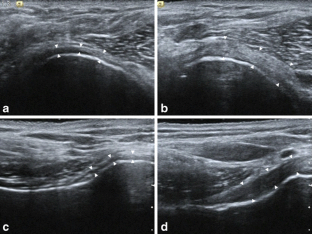 Thickening of the inferior glenohumeral capsule: an ultrasound sign for ...