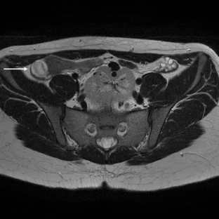 Clinical value of magnetic resonance imaging in patients with Mayer ...