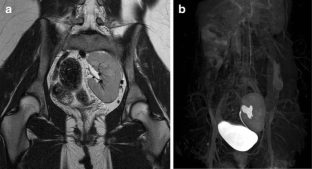 Clinical value of magnetic resonance imaging in patients with Mayer ...